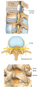 Everything You Need to Know About Diagnostic Spinal Injections | Excel ...