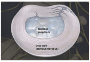 Annular Tear | Excel Spine