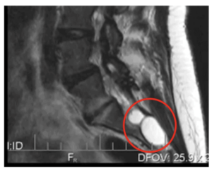 Tarlov Cyst | Excel Spine
