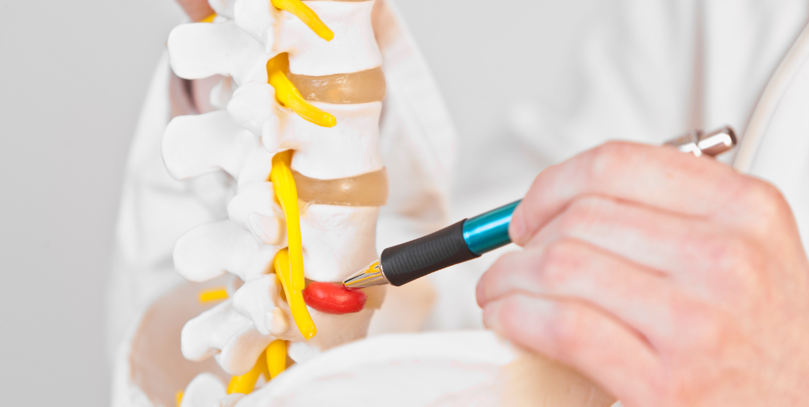 The Truth About Herniated Discs: When Is Surgery Really Needed? | Excel ...
