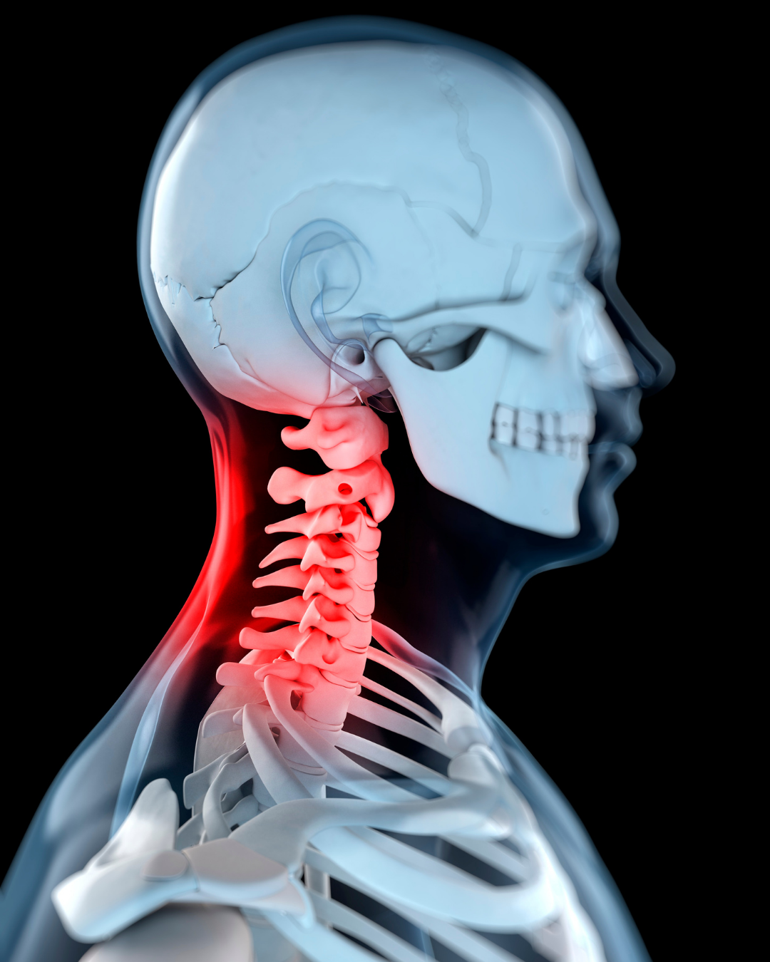 Understanding ACDF: A Clear Path to Neck Pain Relief | Excel Spine